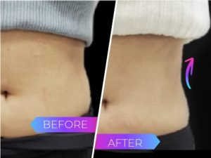 #1 CRYOSCULPTING®/CoolSculpting (Fat Freezing) Treatment In SG