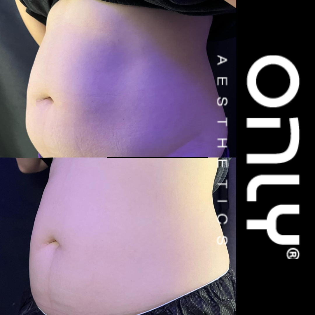 10 Best Non-Invasive Fat Reduction Treatments In Singapore 2025