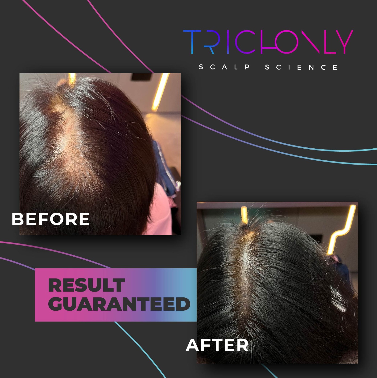 Say Goodbye to Baldness with Scalp Micropigmentation and Hair Tattooing
